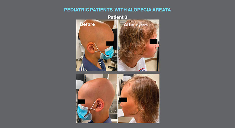 Alopecia Areata | Mount Sinai - New York