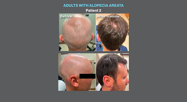 Alopecia Areata | Mount Sinai - New York